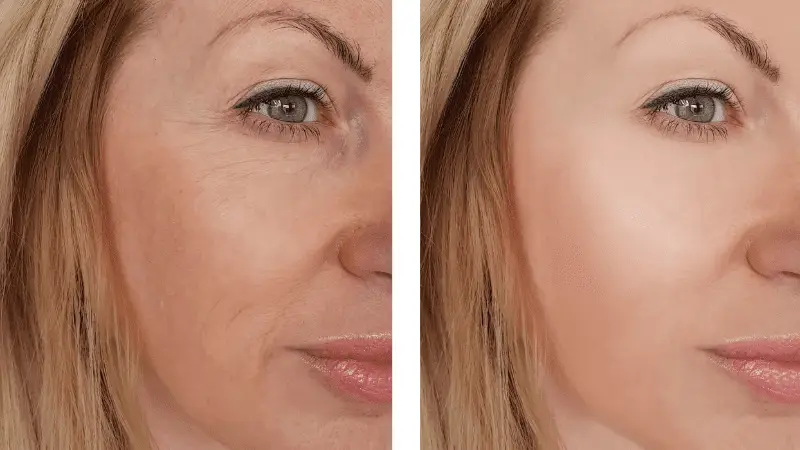 Before and after photos of a woman with wrinkles showcased the ...